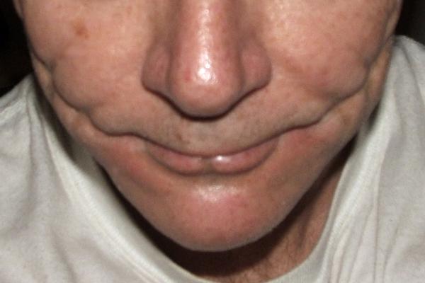 Facial Laceration Scar